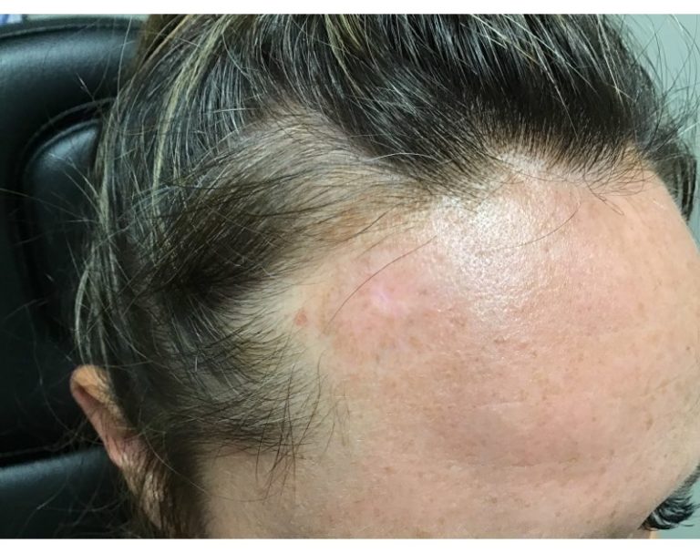 Image-Guided Superficial Radiation Therapy (IG-SRT) Fargo North Dakota ...