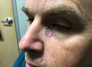 Image-Guided Superficial Radiation Therapy (IG-SRT) Fargo North Dakota ...