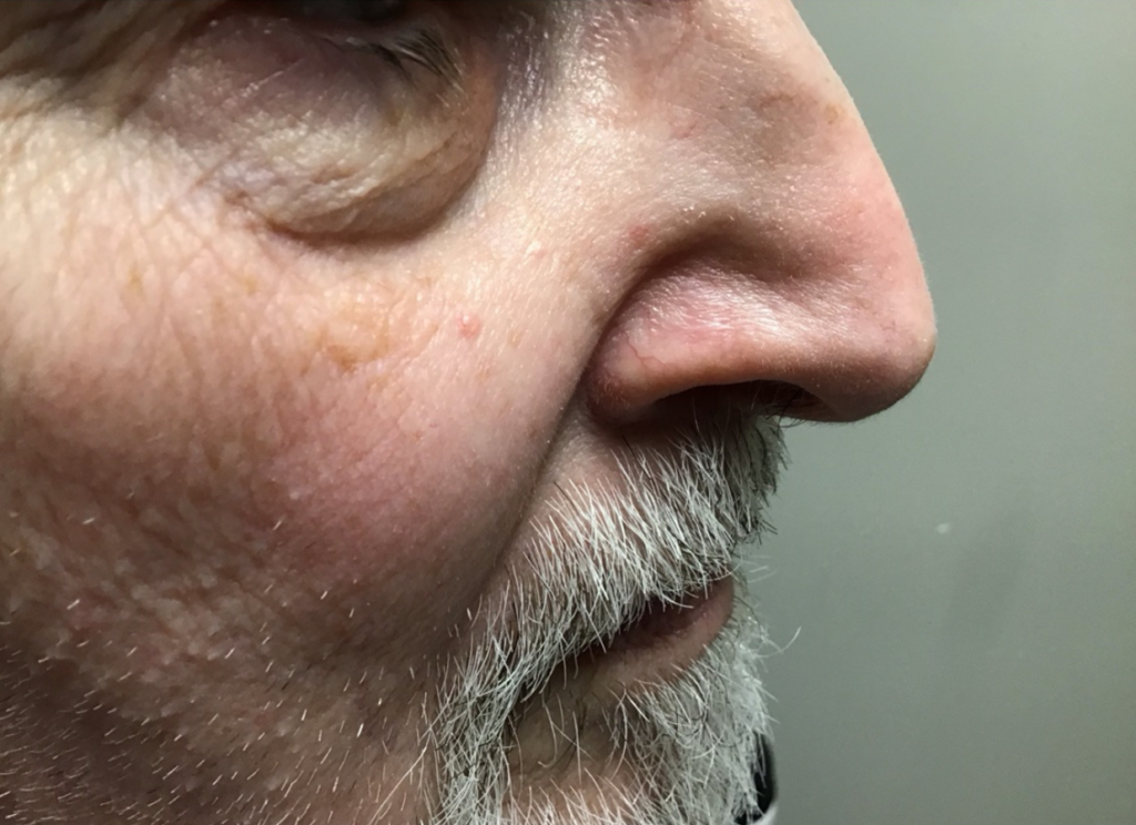 Image-Guided Superficial Radiation Therapy (IG-SRT) Fargo North Dakota ...