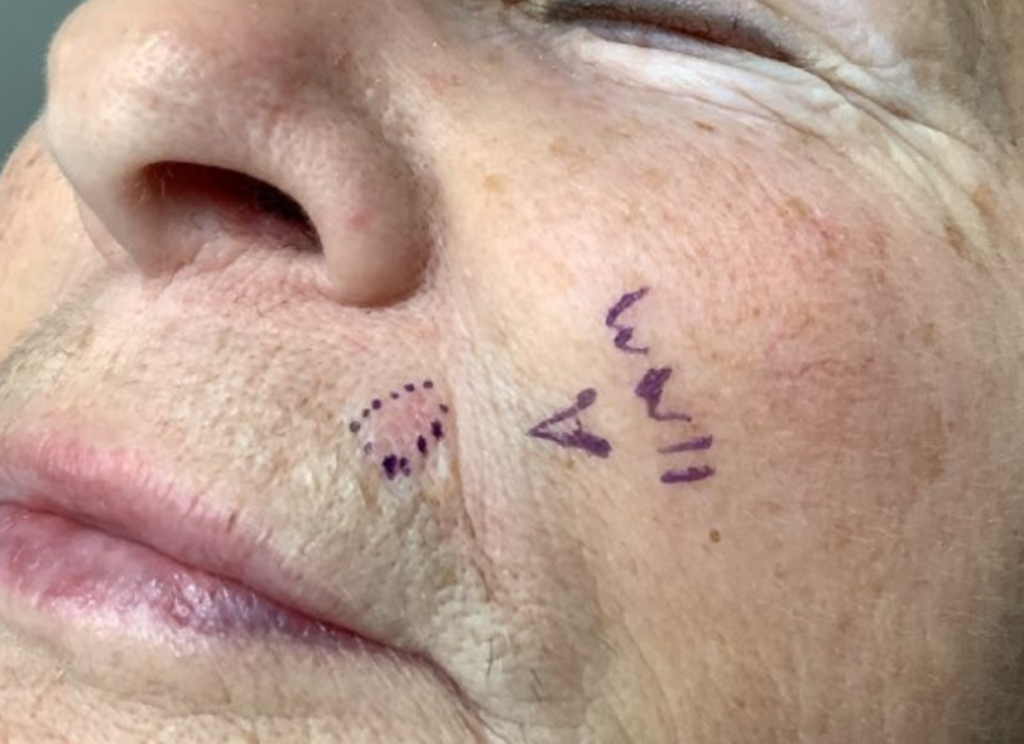 Image-Guided Superficial Radiation Therapy (IG-SRT) Fargo North Dakota ...